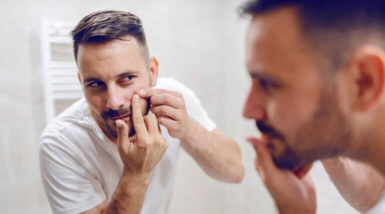 Treating Acne for Adult Males