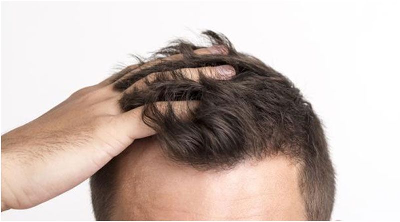 Care For The Donor Area Post Hair Transplant Explained By Hair Transplant Surgeon In Surat